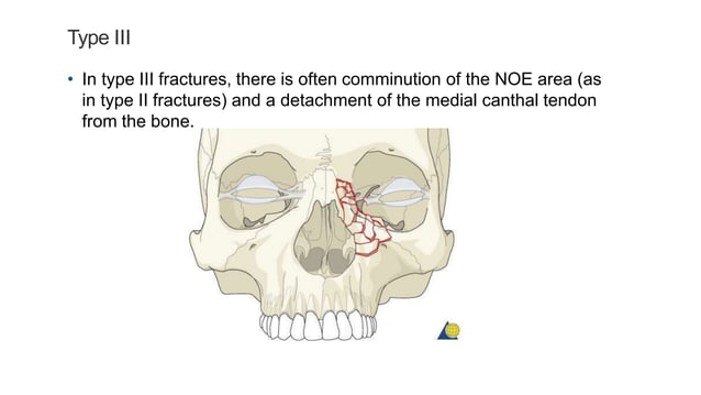 Classification, clinical features of pan facial trauma | PPTX
