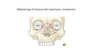 Classification, clinical features of pan facial trauma | PPTX