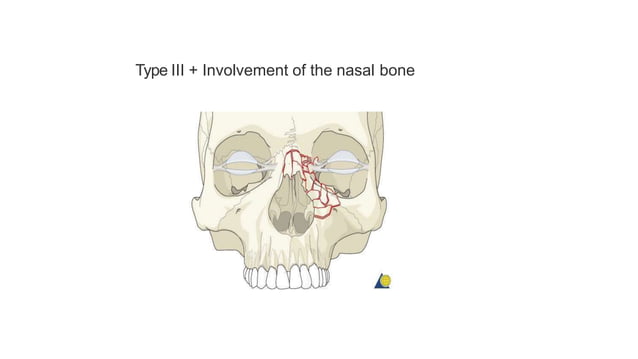 Classification, clinical features of pan facial trauma