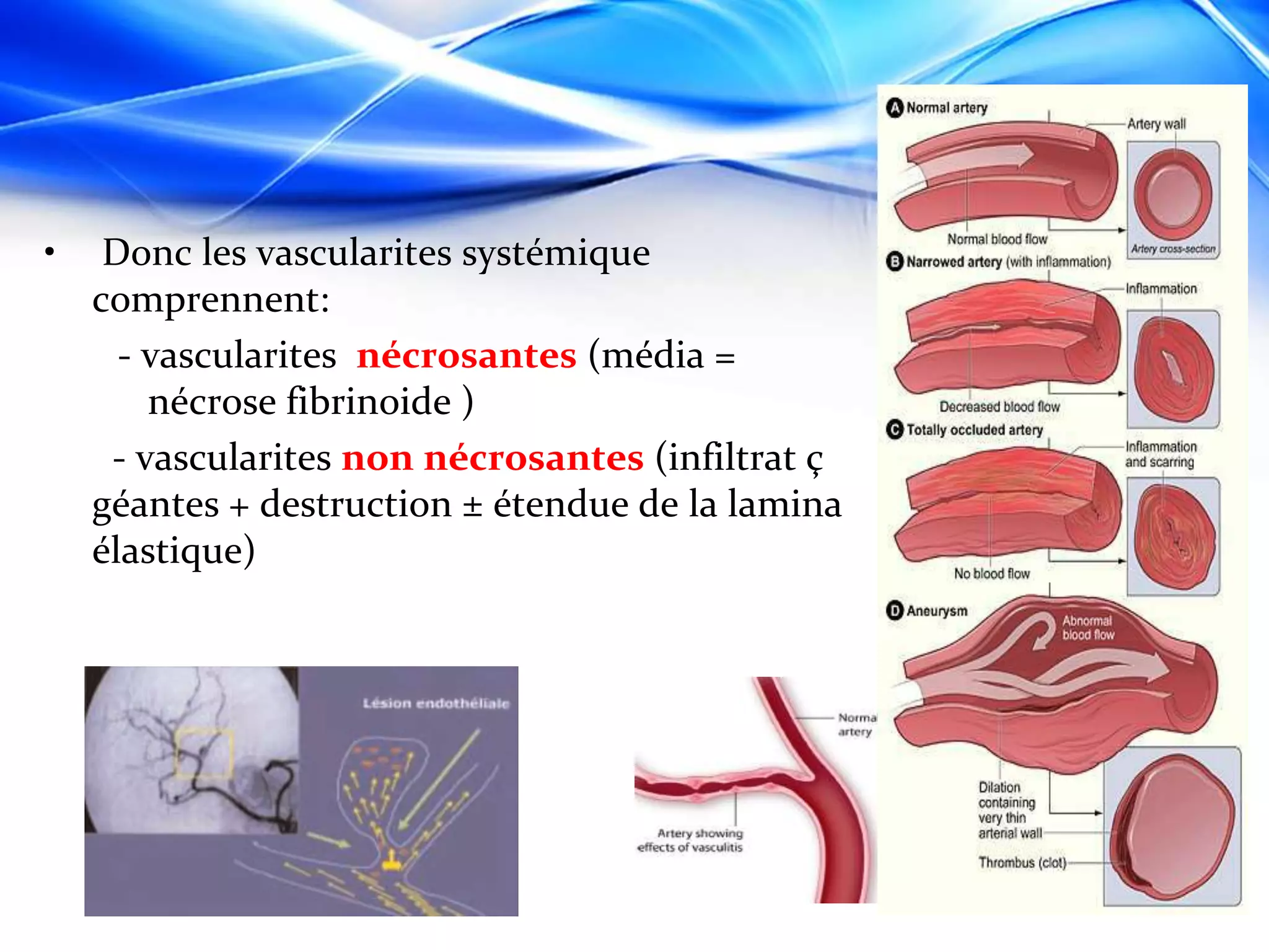 Classification of vasculitis