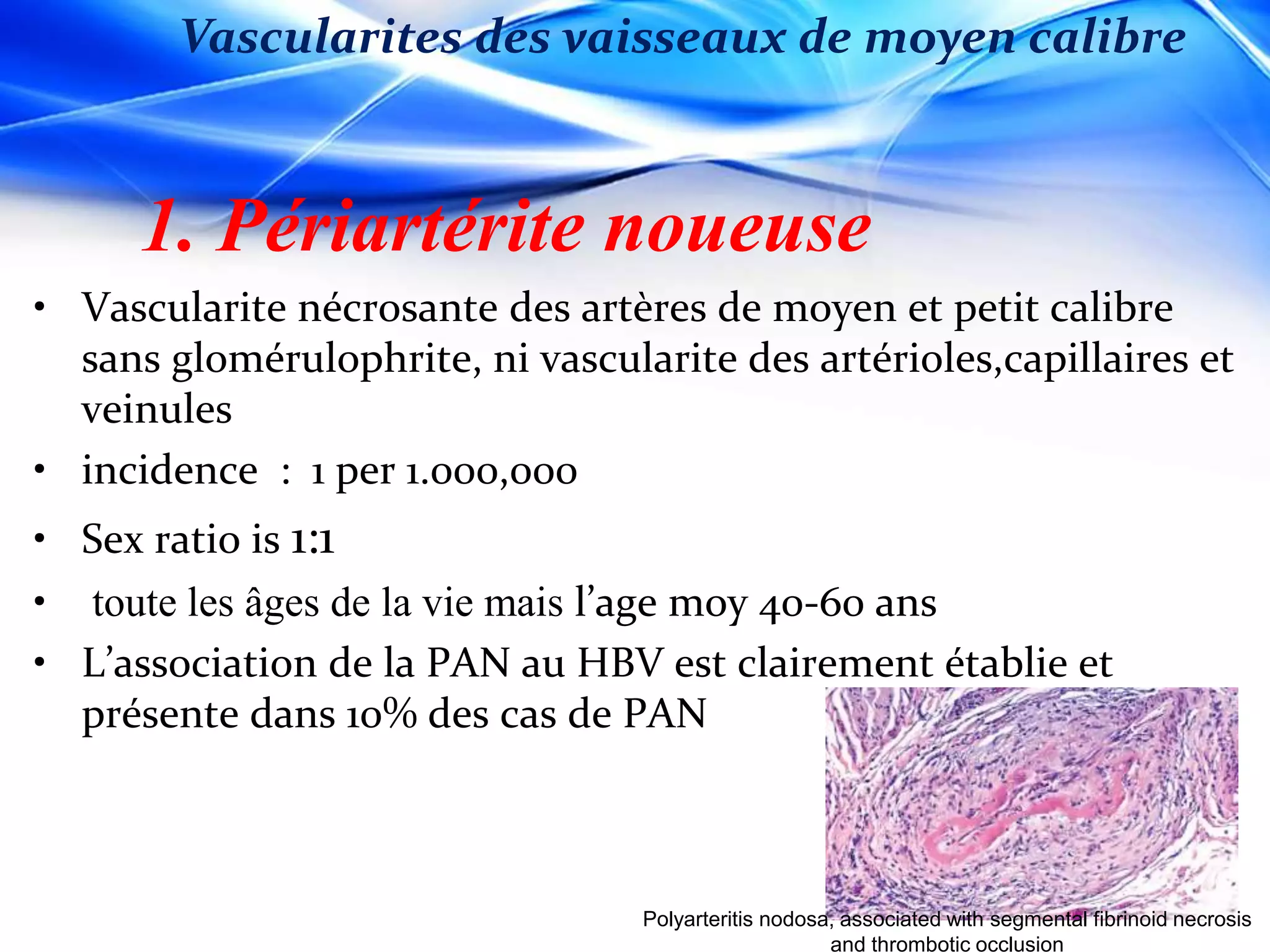Classification of vasculitis