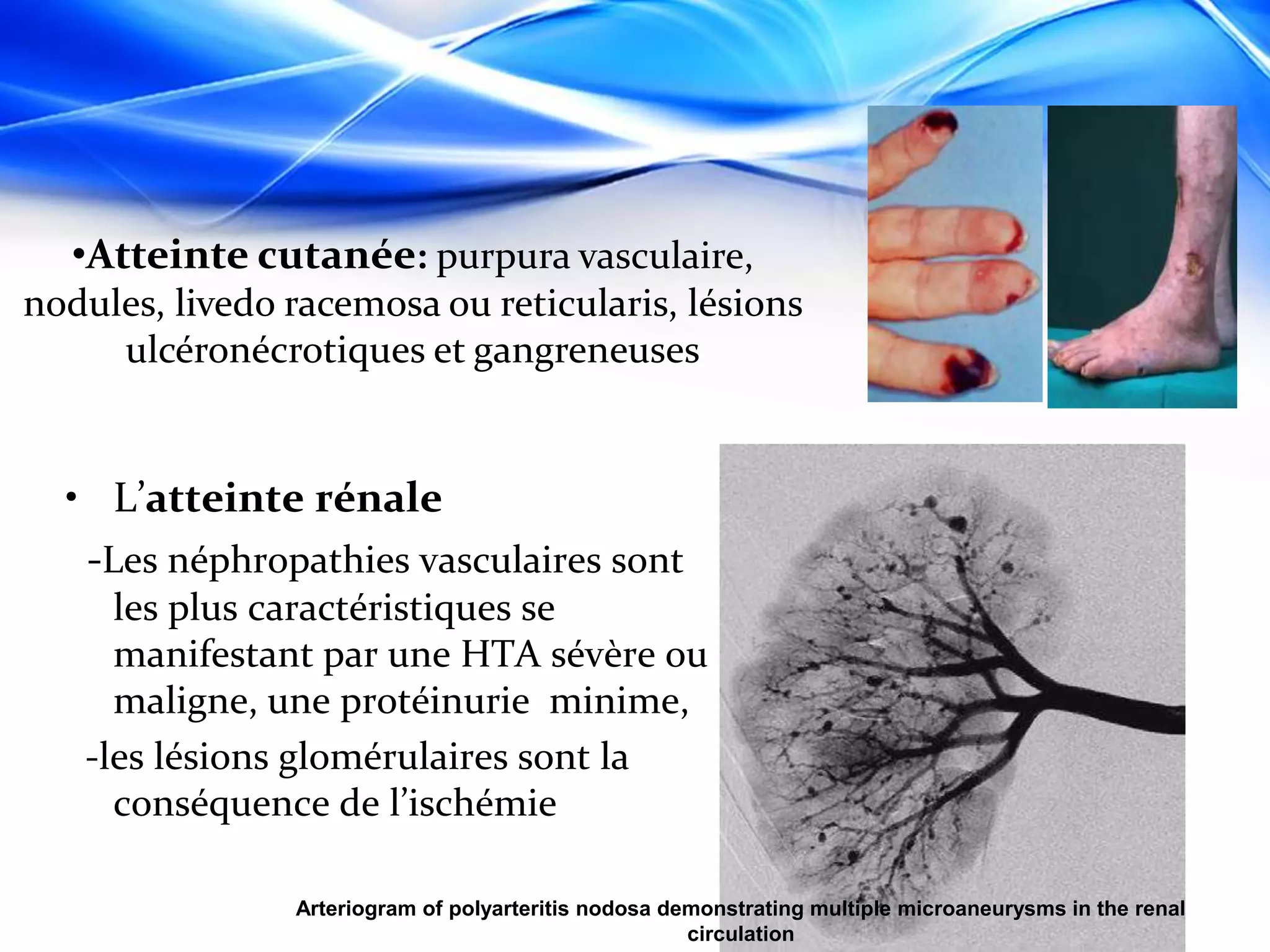 Classification of vasculitis