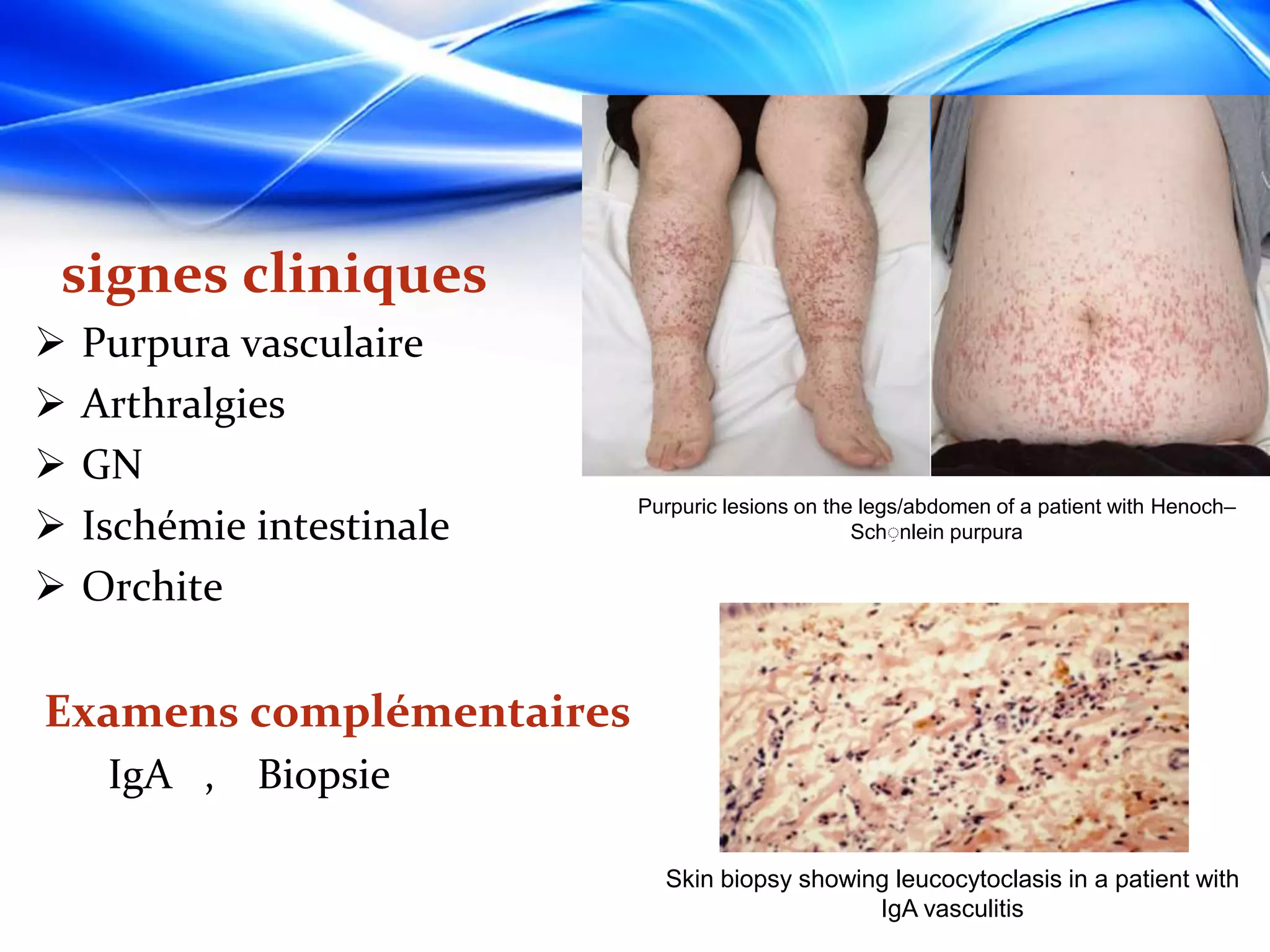 Classification of vasculitis