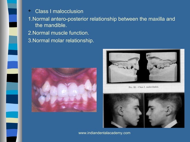Classification & etiology of malocclusion | PPT