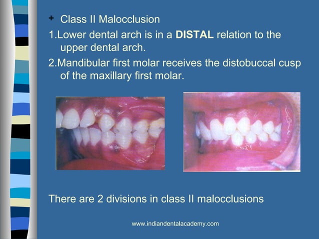 Classification & etiology of malocclusion | PPT
