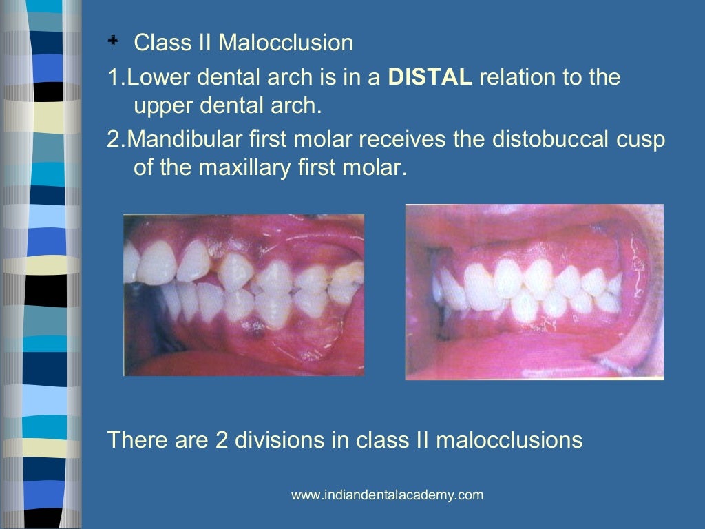 Classification & etiology of malocclusion