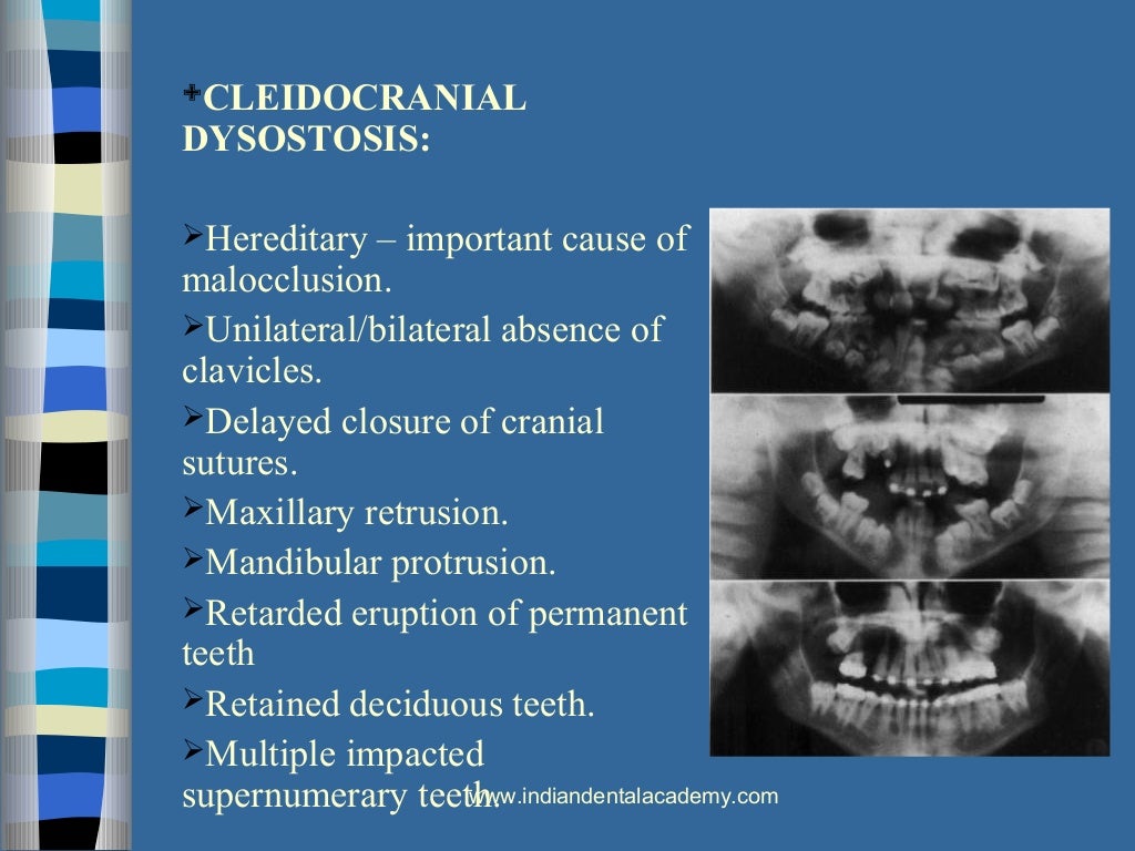 Classification & etiology of malocclusion