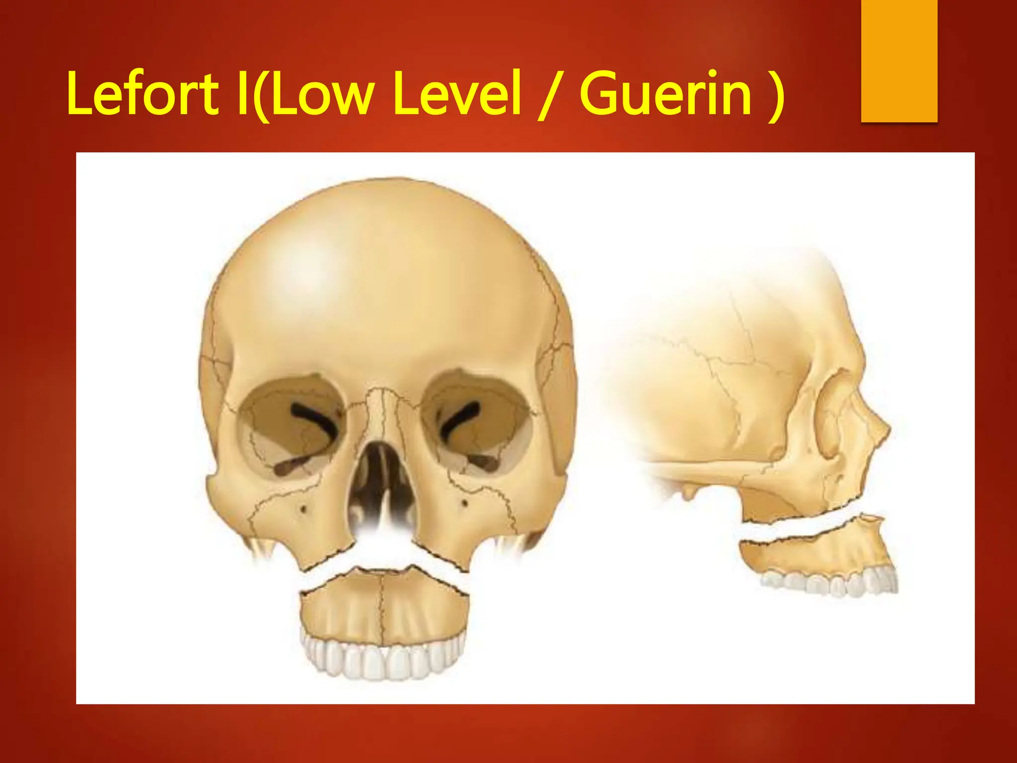 classificationfacialfracturekamini-200801184051.pptx