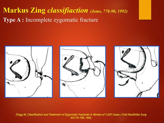 classificationfacialfracturekamini-200801184051.pptx