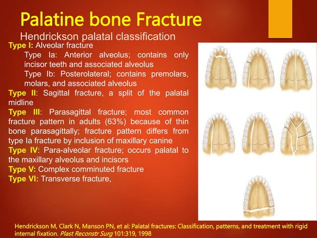 classificationfacialfracturekamini-200801184051.pptx