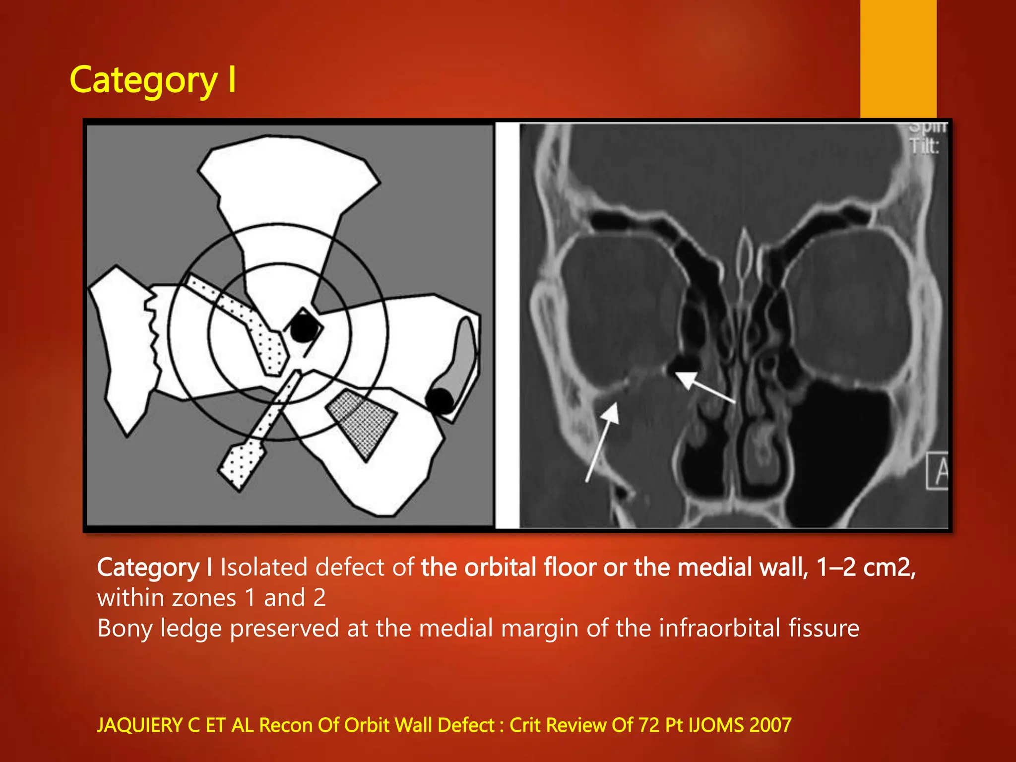 classificationfacialfracturekamini-200801184051.pptx