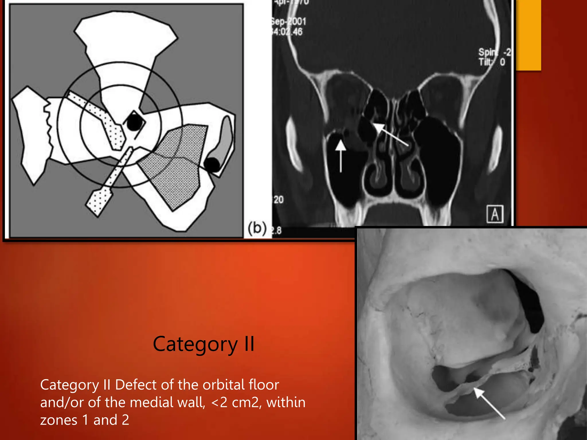 classificationfacialfracturekamini-200801184051.pptx