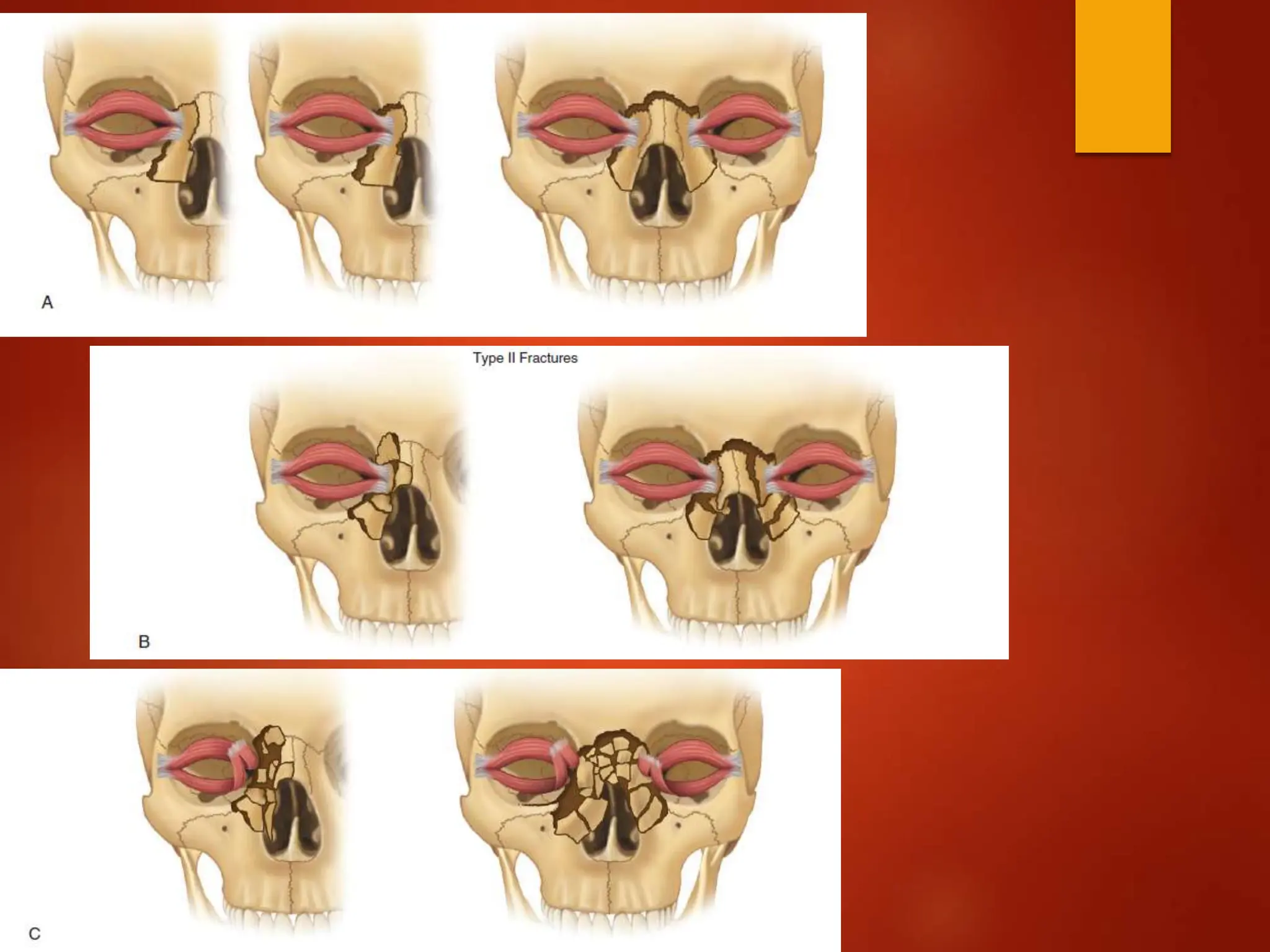 classificationfacialfracturekamini-200801184051.pptx
