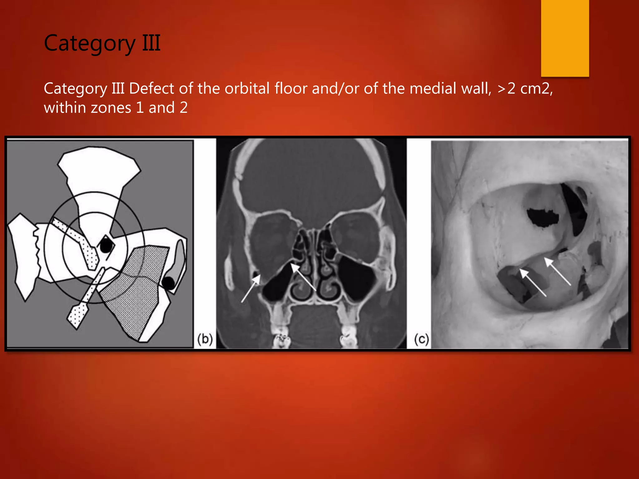 Classification facial fracture current concept | PPTX