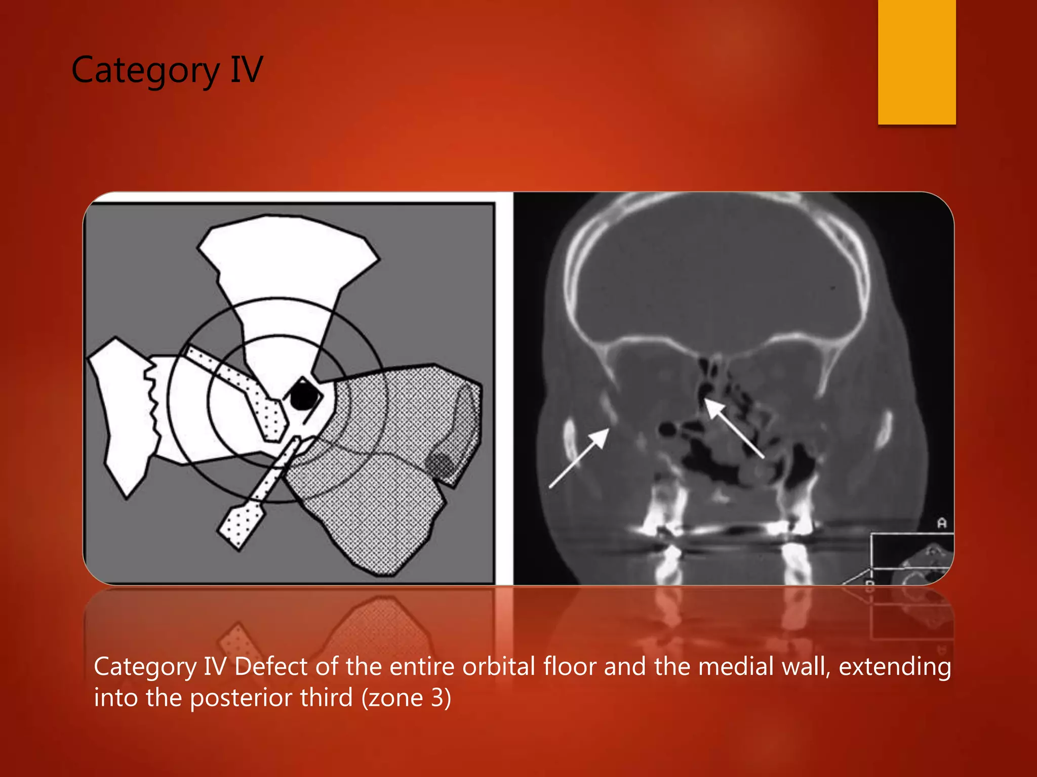 Classification facial fracture current concept | PPTX