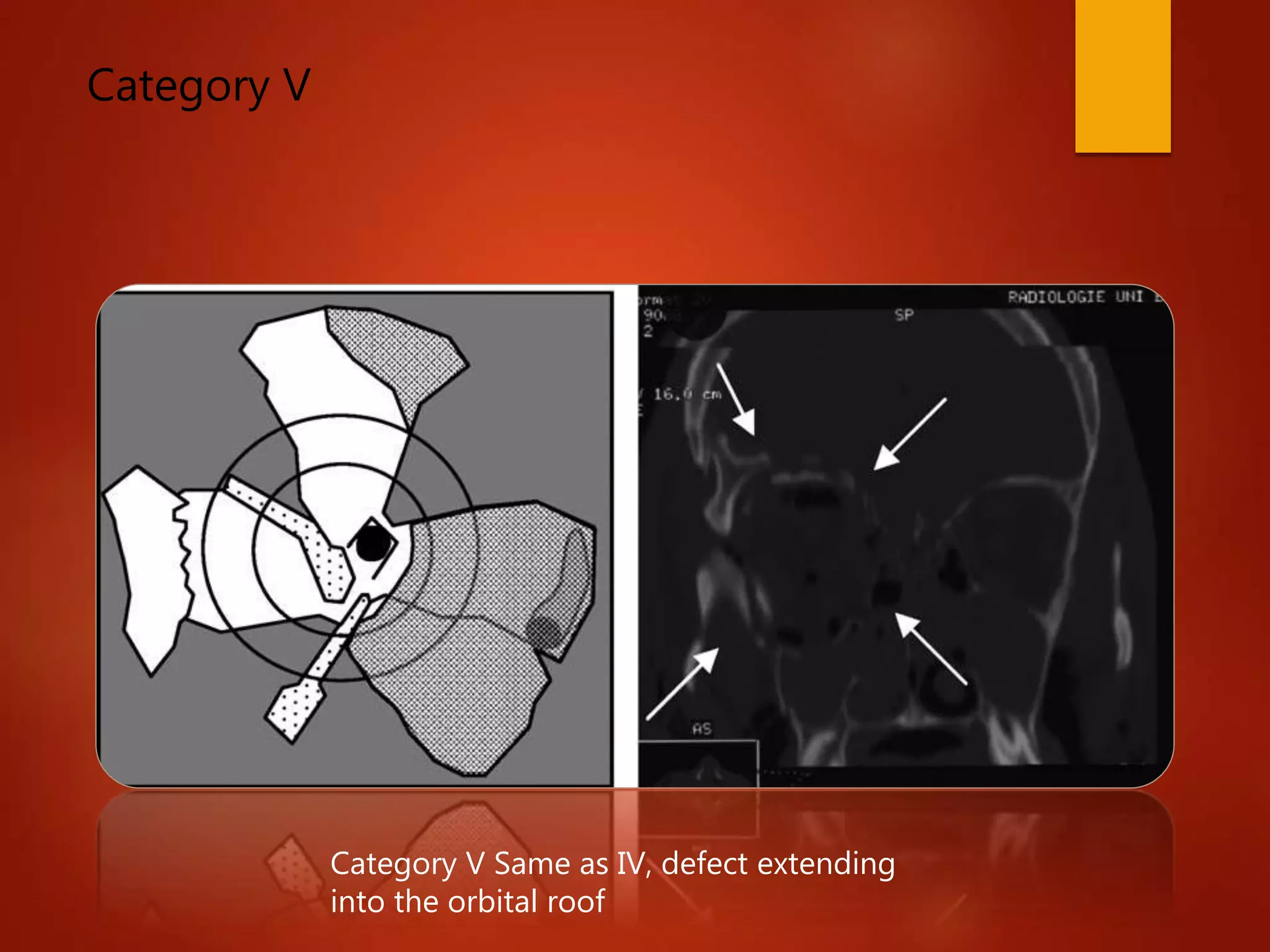 Classification facial fracture current concept | PPTX