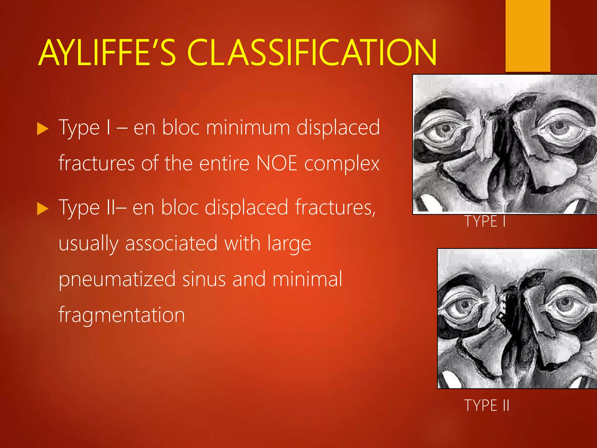 Classification facial fracture current concept | PPTX
