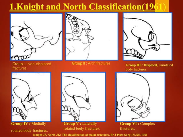 Classification facial fracture current concept | PPTX