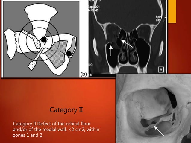 Classification facial fracture current concept | PPTX
