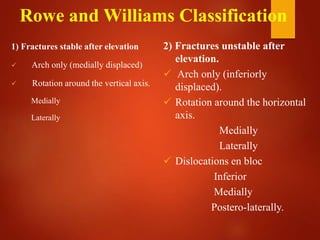 Classification facial fracture current concept | PPT