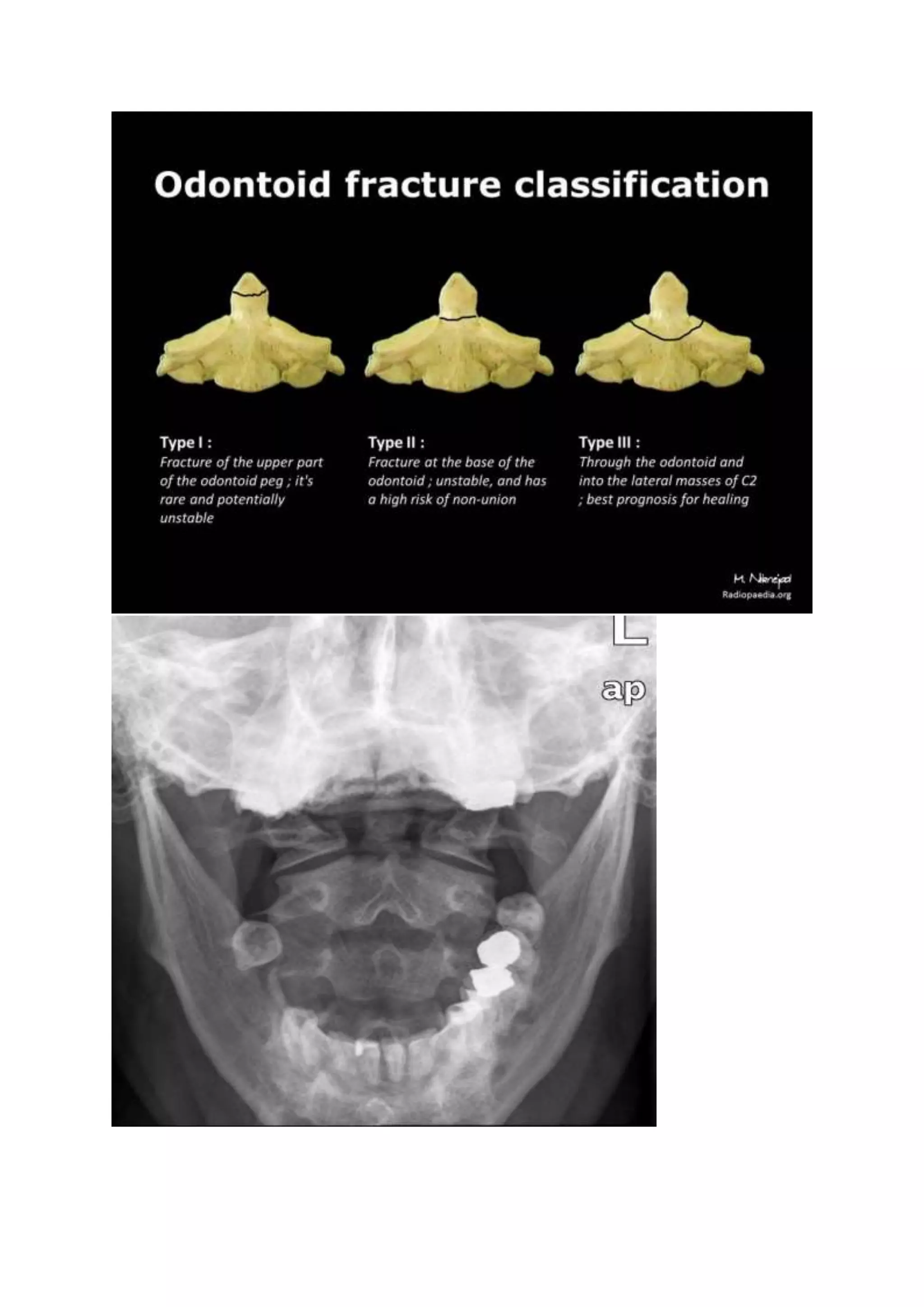 Important radiological classification of fracture and AVN | DOCX