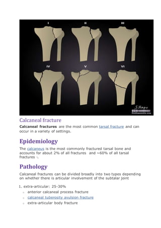 Important radiological classification of fracture and AVN | DOCX