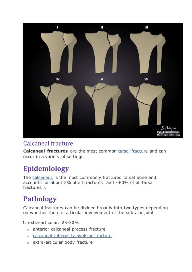 Important radiological classification of fracture and AVN | PDF