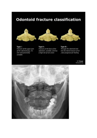 Important radiological classification of fracture and AVN | DOCX