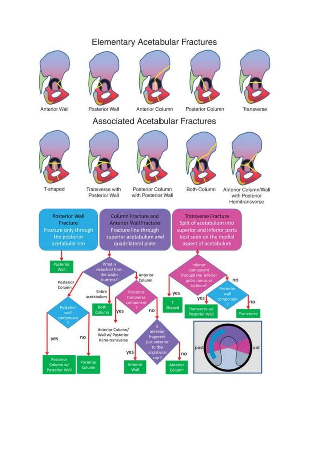 Important radiological classification of fracture and AVN | PDF