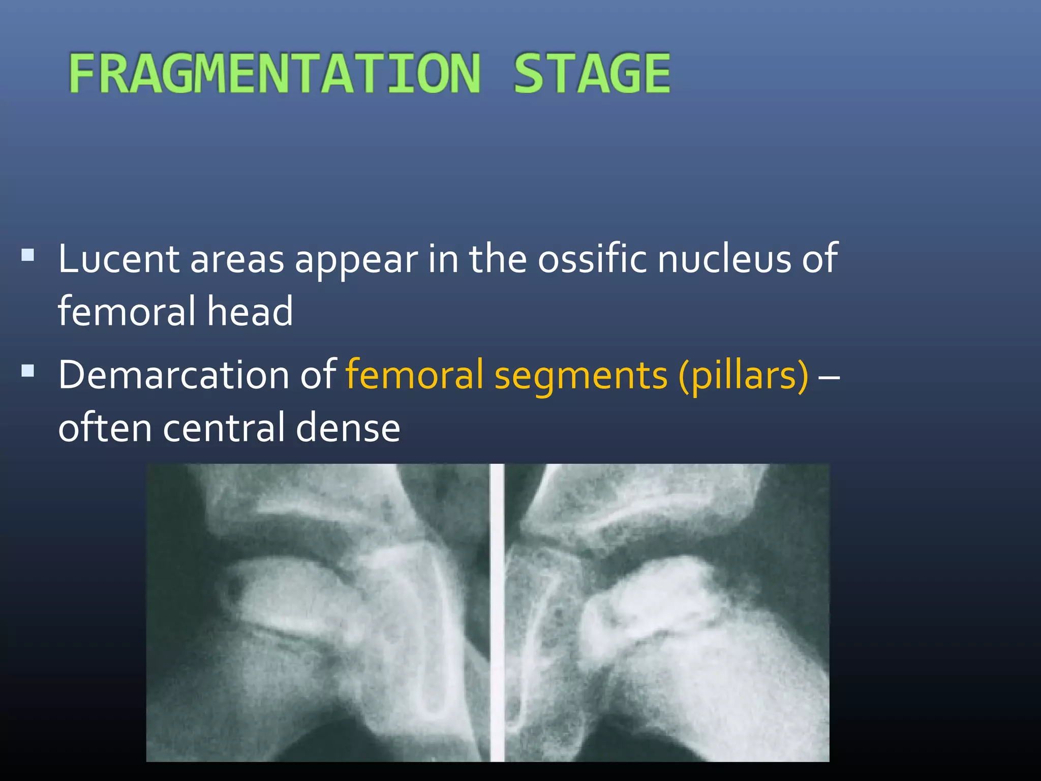 Classification & management of legg calve perthes disease | PPT