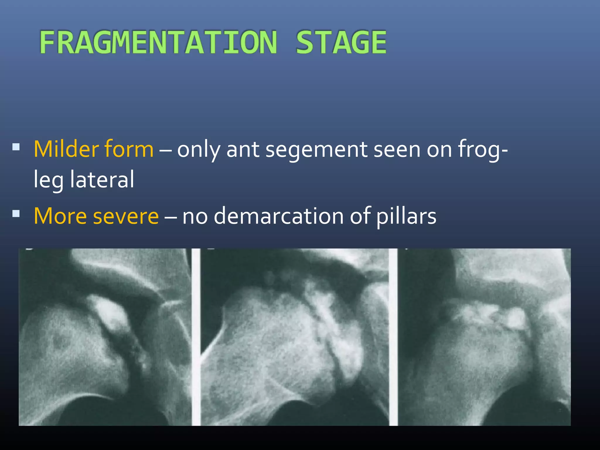 Classification & management of legg calve perthes disease | PPT