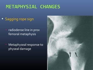 Classification & management of legg calve perthes disease | PPT