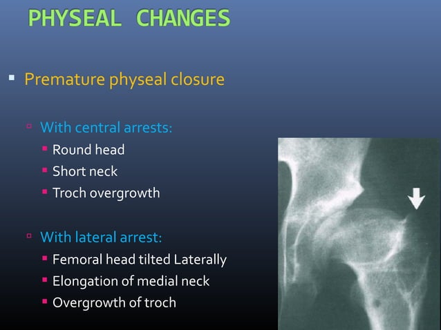 Classification & management of legg calve perthes disease | PPT | Bone ...