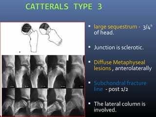 Classification & management of legg calve perthes disease | PPT