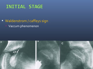 Classification & management of legg calve perthes disease | PPT