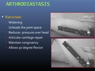 Classification & management of legg calve perthes disease | PPT