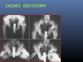 Classification & management of legg calve perthes disease | PPT