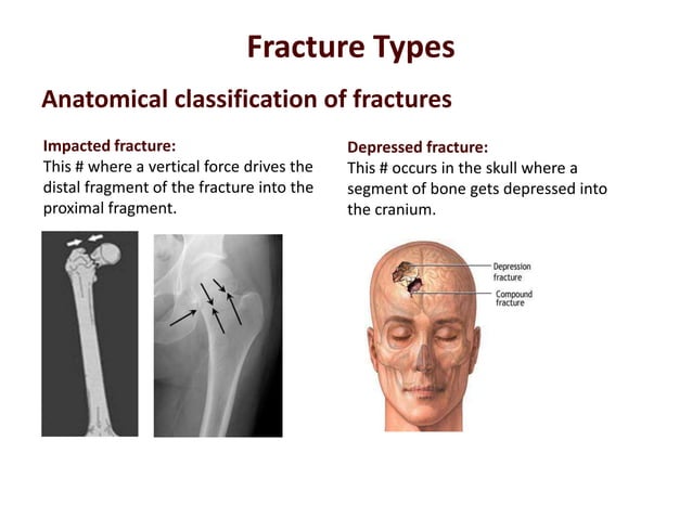 Classification of fractures in general | PPTX | Death, Injury, or ...