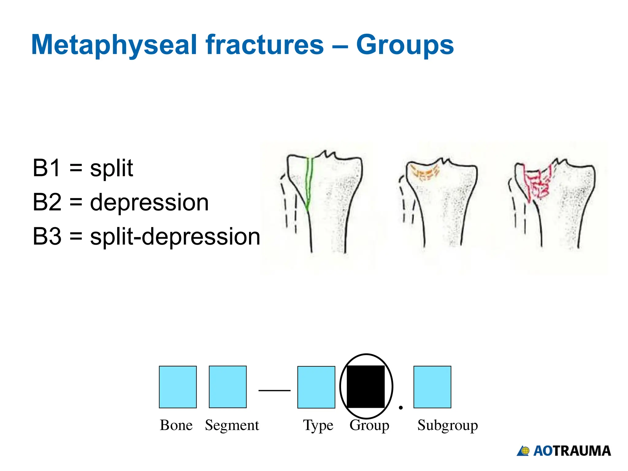 classification of fractures&$&$$$)$.pptx