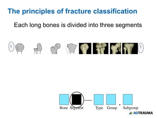 classification of fractures&$&$$$)$.pptx