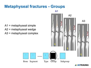 classification of fractures&$&$$$)$.pptx
