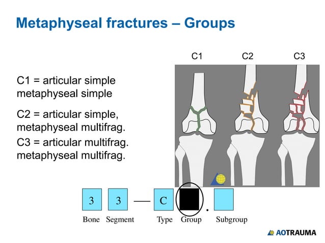 classification of fractures&$&$$$)$.pptx
