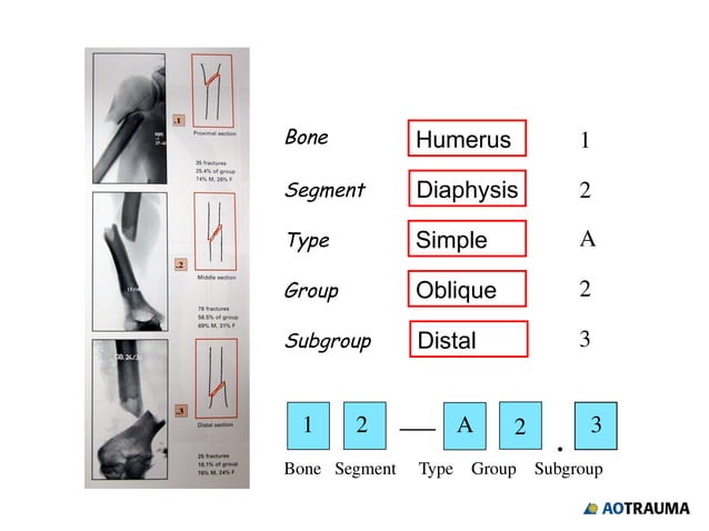 classification of fractures&$&$$$)$.pptx