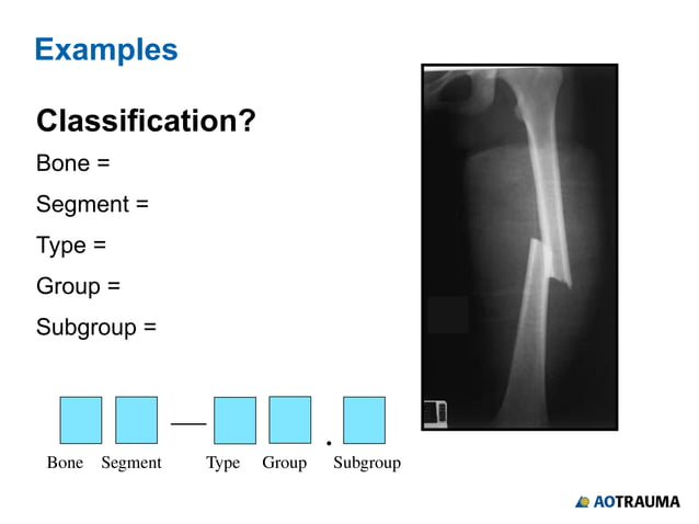 classification of fractures&$&$$$)$.pptx
