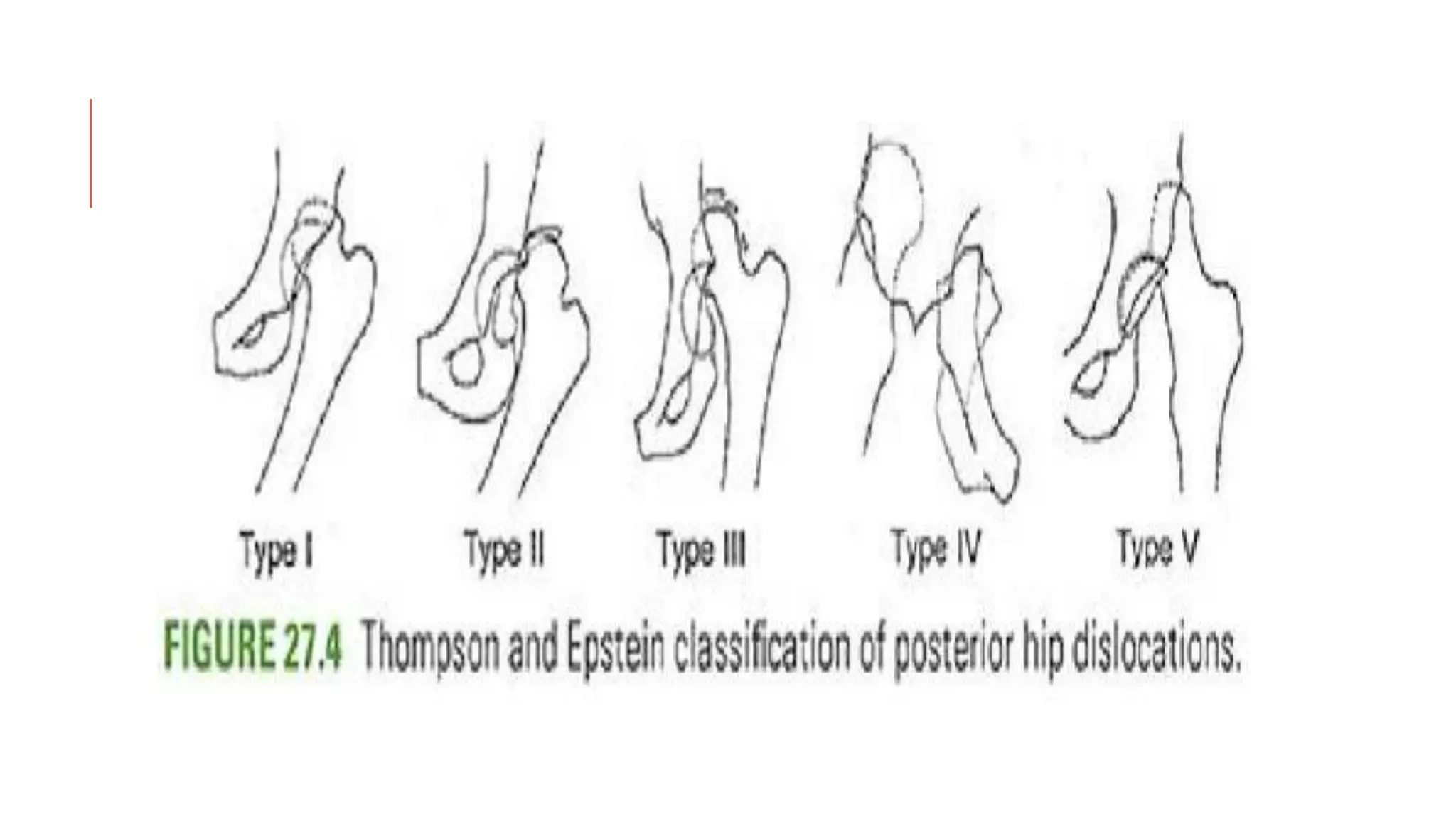 Classification of acetabular fractures | PPTX