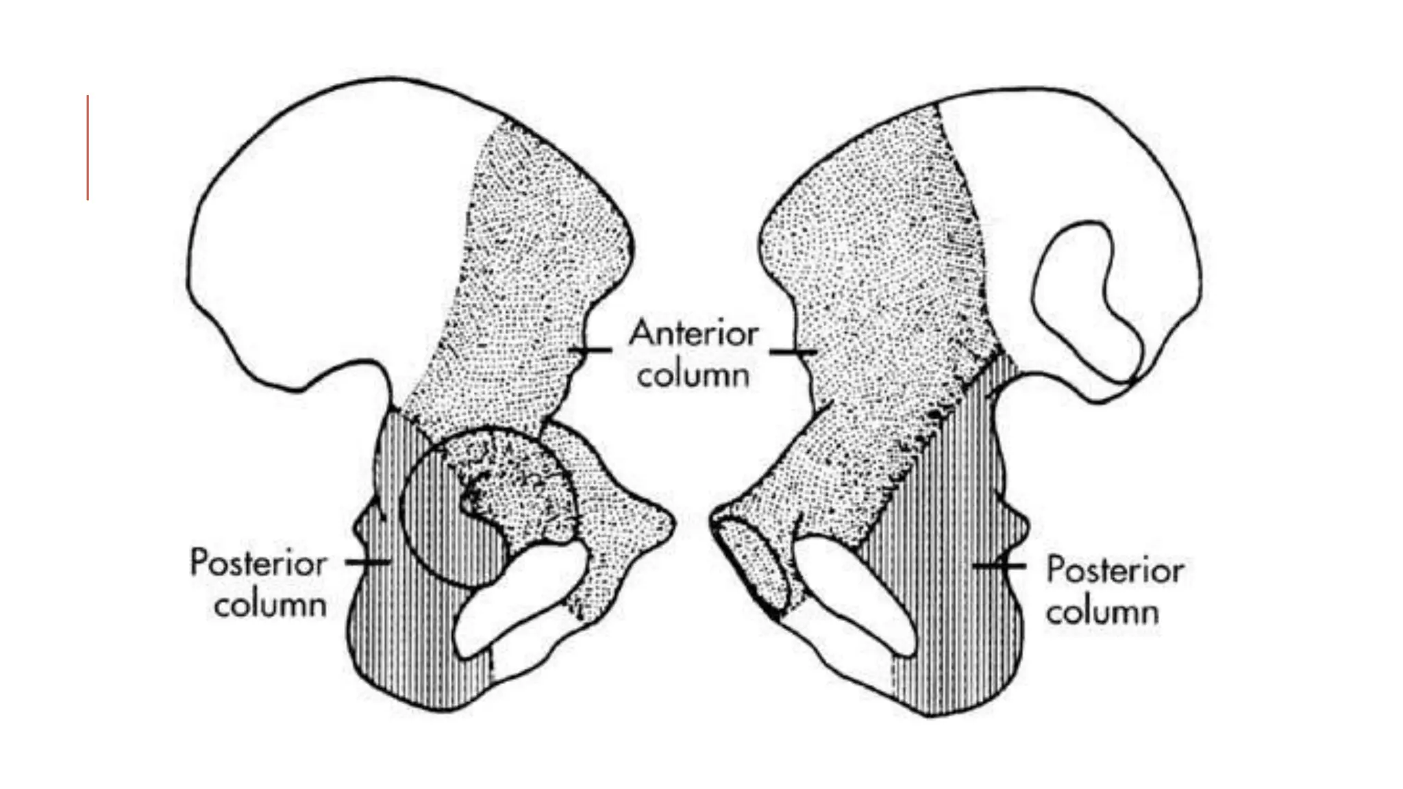 Classification of acetabular fractures | PPTX