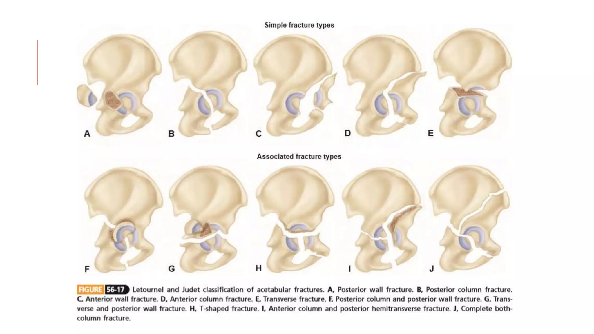 Classification of acetabular fractures | PPTX
