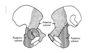 Classification of acetabular fractures | PPTX