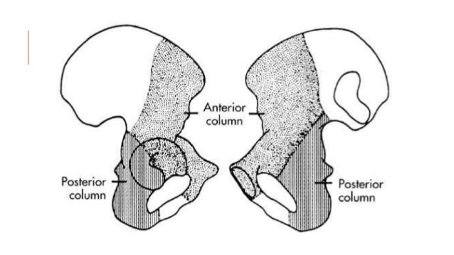 Classification of acetabular fractures
