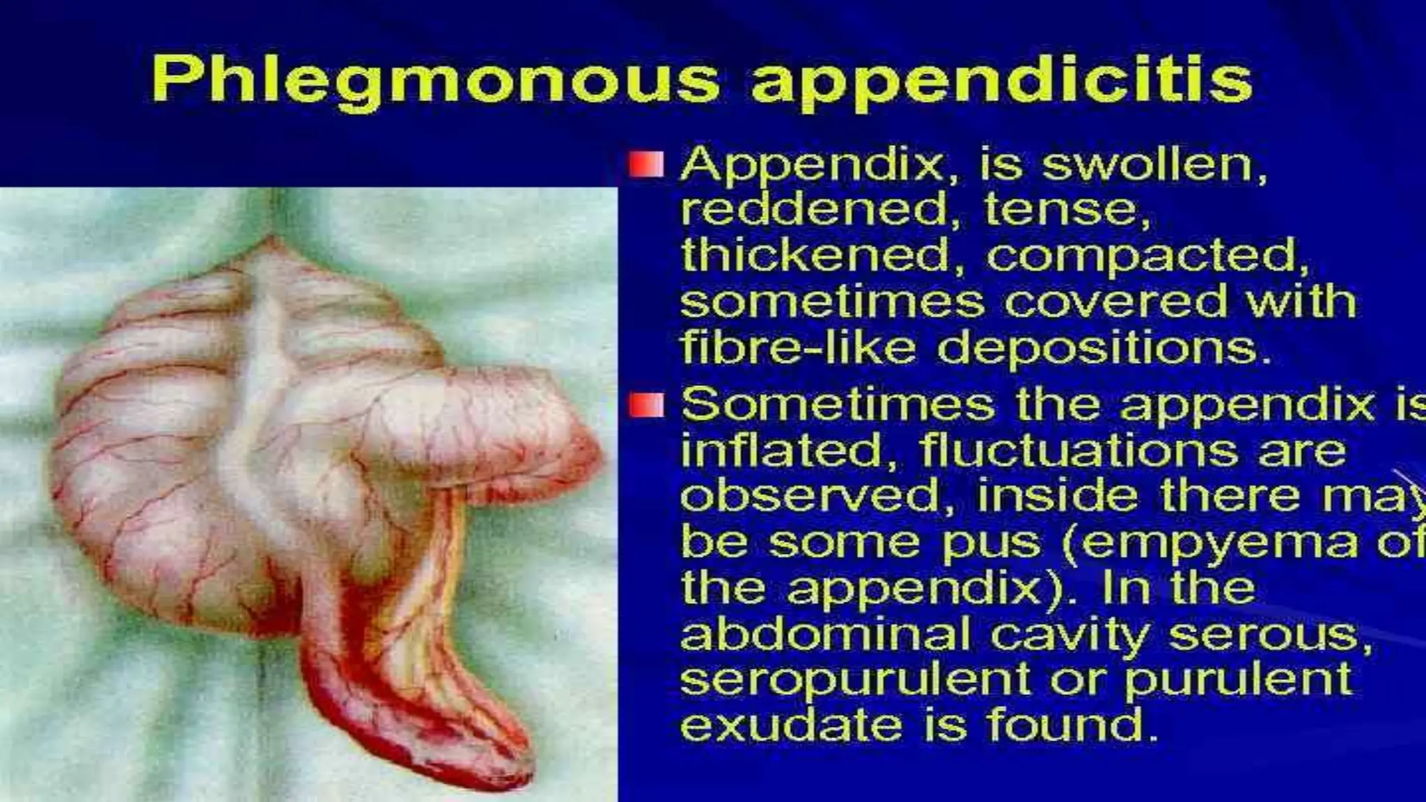 Classification of acute appendicitis.pptx